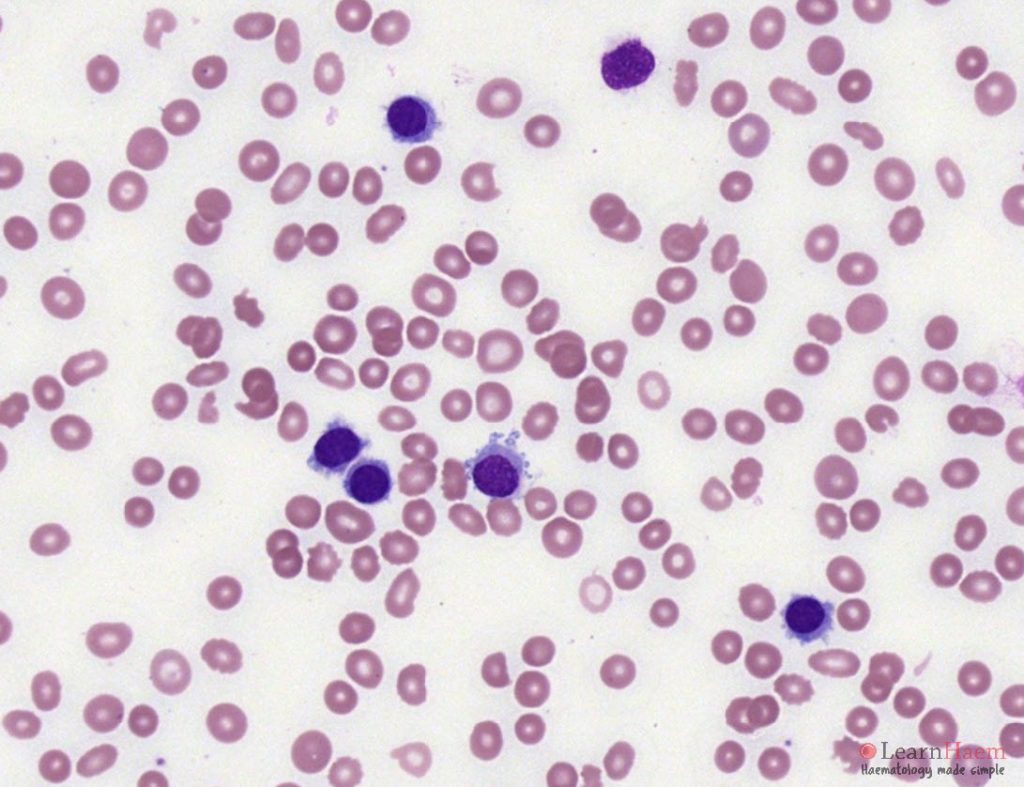 Hairy Cell Leukaemia - LearnHaem | Haematology Made Simple