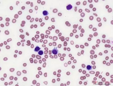 Hairy Cell Leukaemia - LearnHaem | Haematology Made Simple