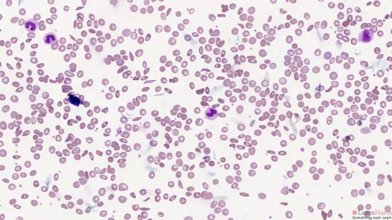 Haemoglobin SC Disease - LearnHaem | Haematology Made Simple