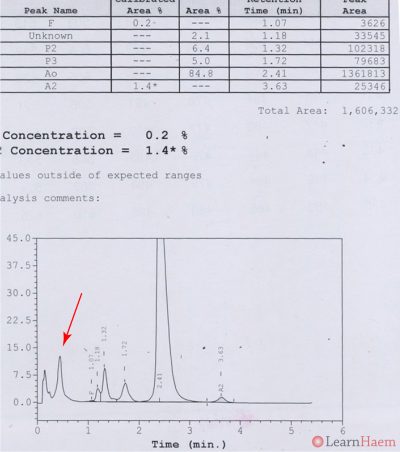 Haemoglobin H (HbH) Disease - LearnHaem | Haematology Made Simple