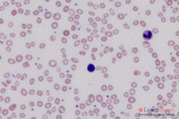 Microcytosis - LearnHaem | Haematology Made Simple