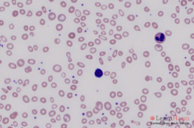 Microcytosis - LearnHaem | Haematology Made Simple