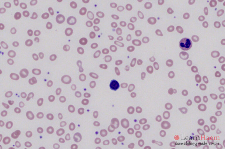 Microcytosis - LearnHaem | Haematology Made Simple