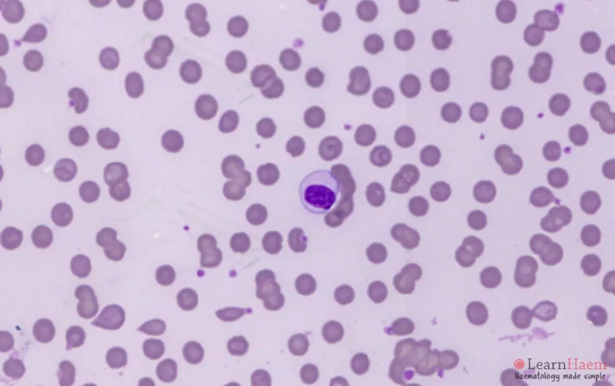 Lymphoplasmacytic Lymphoma - LearnHaem | Haematology Made Simple