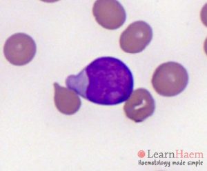 Acute Lymphoblastic Leukaemia - LearnHaem | Haematology Made Simple