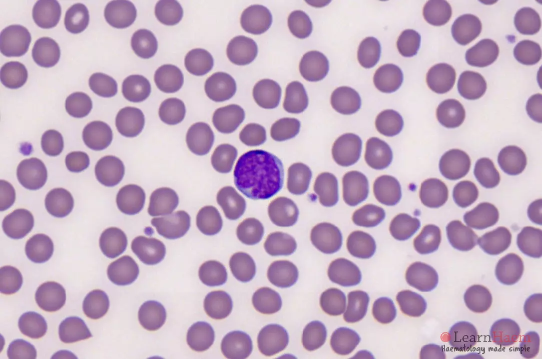 Mantle Cell Lymphoma - LearnHaem | Haematology Made Simple
