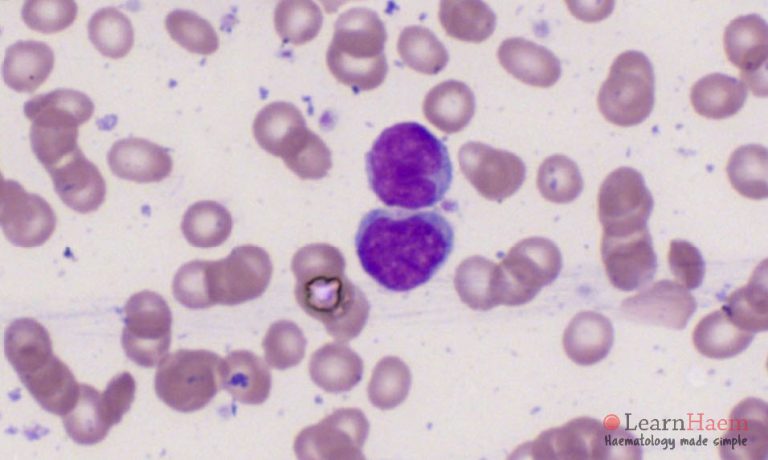 Mantle Cell Lymphoma - LearnHaem | Haematology Made Simple