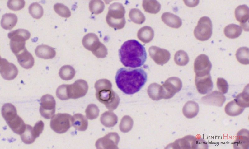 Mantle Cell Lymphoma - LearnHaem | Haematology Made Simple