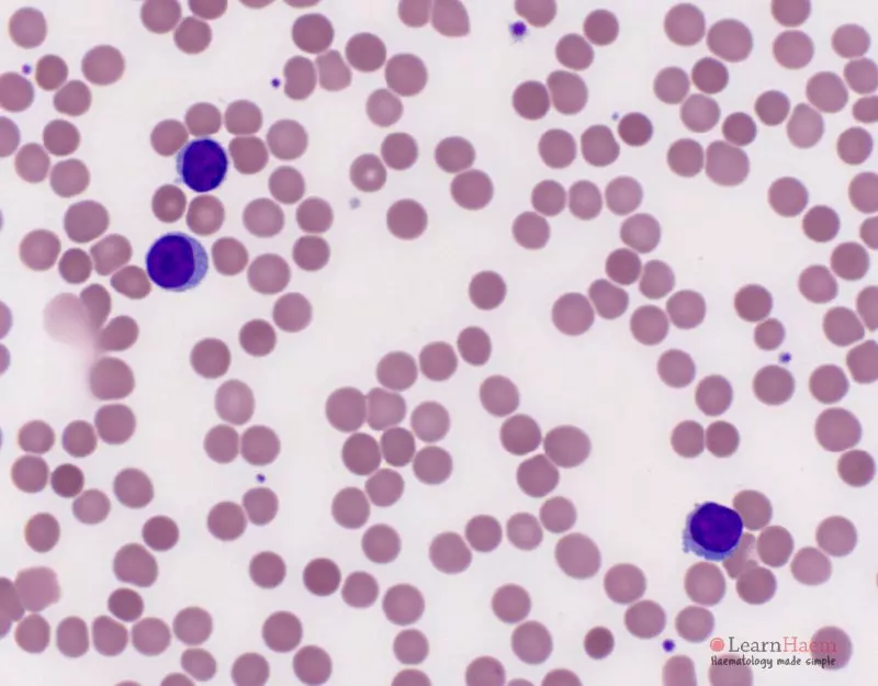 Mantle Cell Lymphoma - LearnHaem | Haematology Made Simple