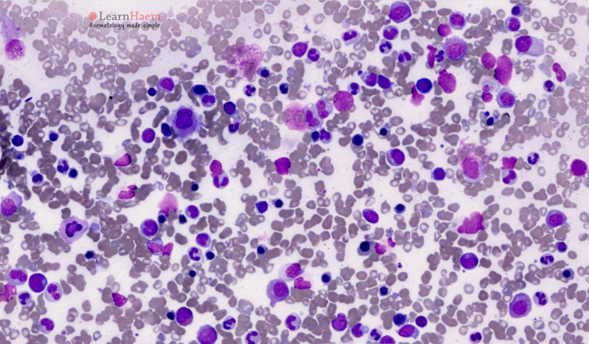 MDS with Multilineage Dysplasia and Ringed Sideroblasts - LearnHaem ...