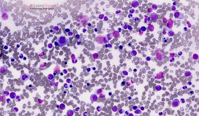 MDS with Multilineage Dysplasia and Ringed Sideroblasts - LearnHaem ...