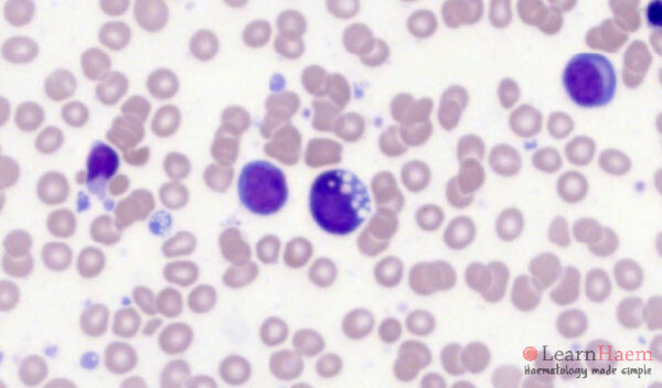 Multiple Myeloma - LearnHaem | Haematology Made Simple