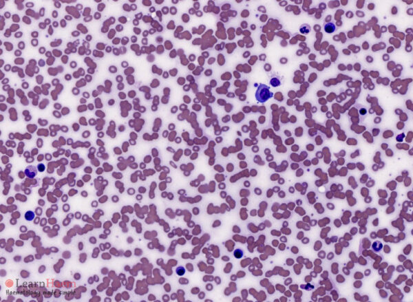 Multiple Myeloma - LearnHaem | Haematology Made Simple