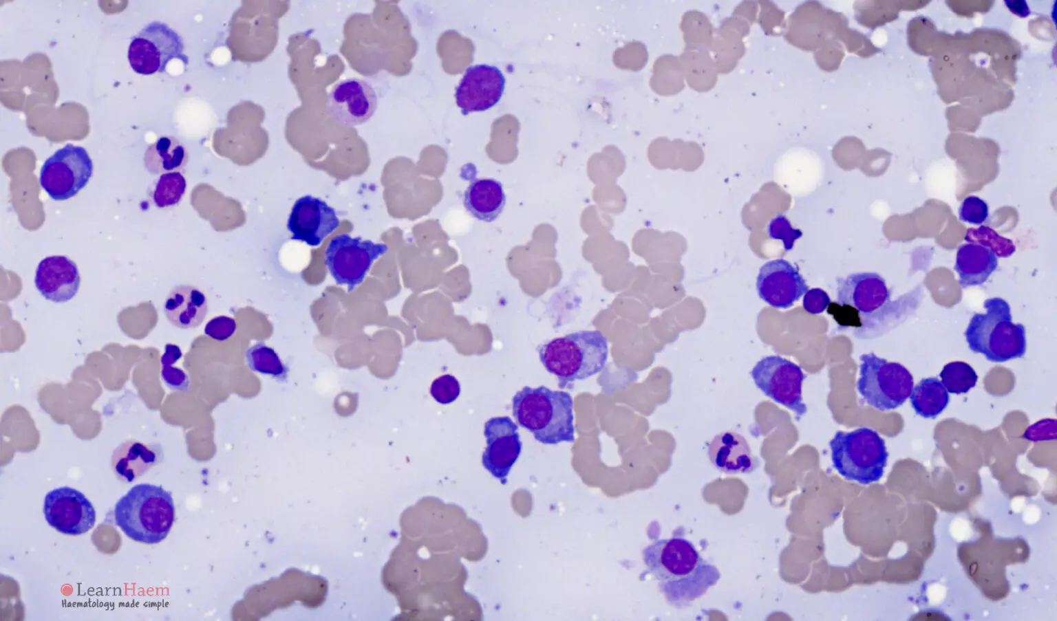 Multiple Myeloma - LearnHaem | Haematology Made Simple