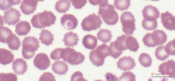 P. malariae - LearnHaem | Haematology Made Simple