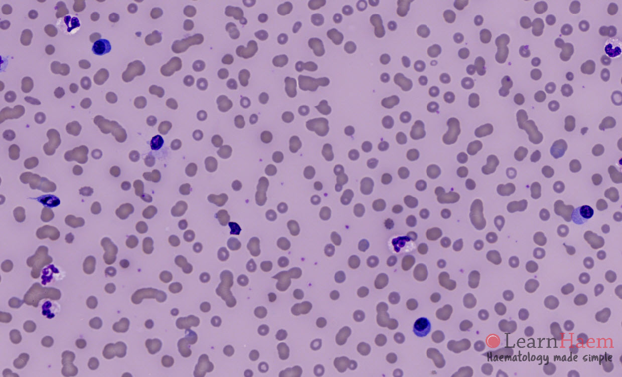 Plasma Cell Leukaemia - LearnHaem | Haematology Made Simple
