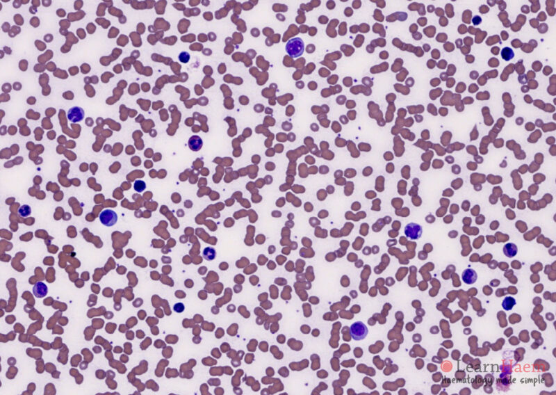 Plasma Cell Leukaemia - LearnHaem | Haematology Made Simple