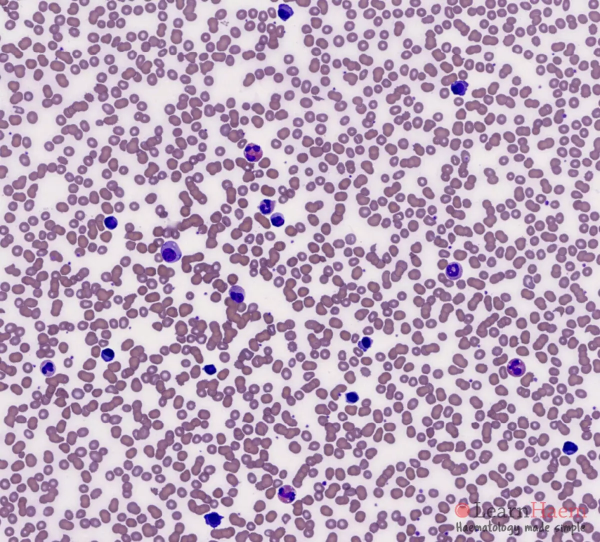 Plasma Cell Leukaemia - LearnHaem | Haematology Made Simple