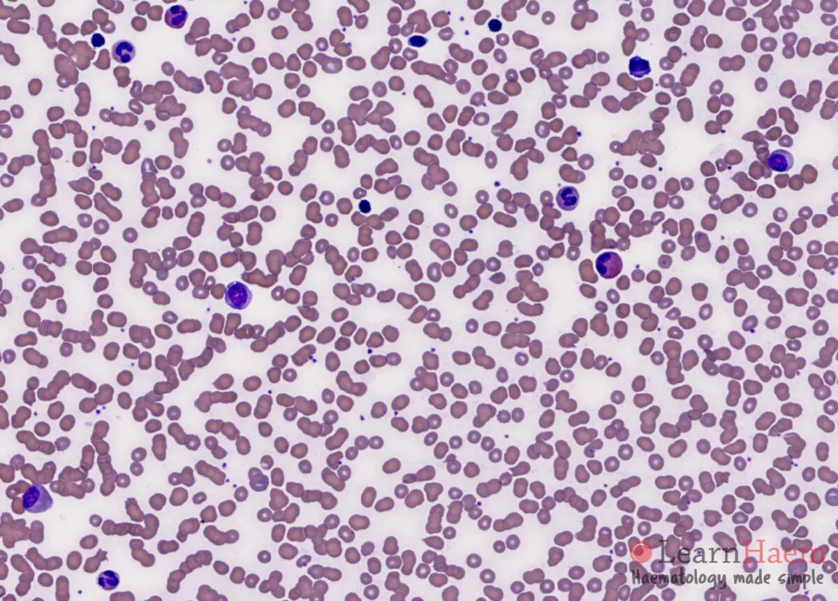 Plasma Cell Leukaemia - LearnHaem | Haematology Made Simple