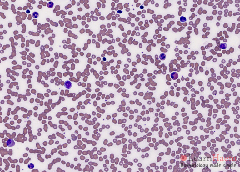 Plasma Cell Leukaemia - LearnHaem | Haematology Made Simple