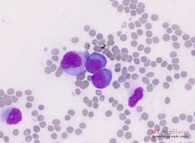 Multiple Myeloma - LearnHaem | Haematology Made Simple