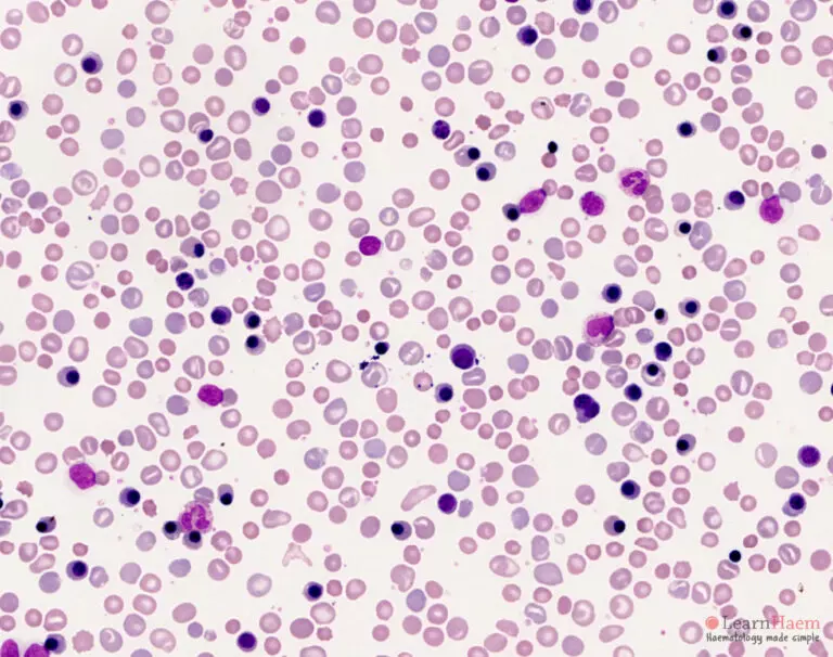 Polychromasia - LearnHaem | Haematology Made Simple