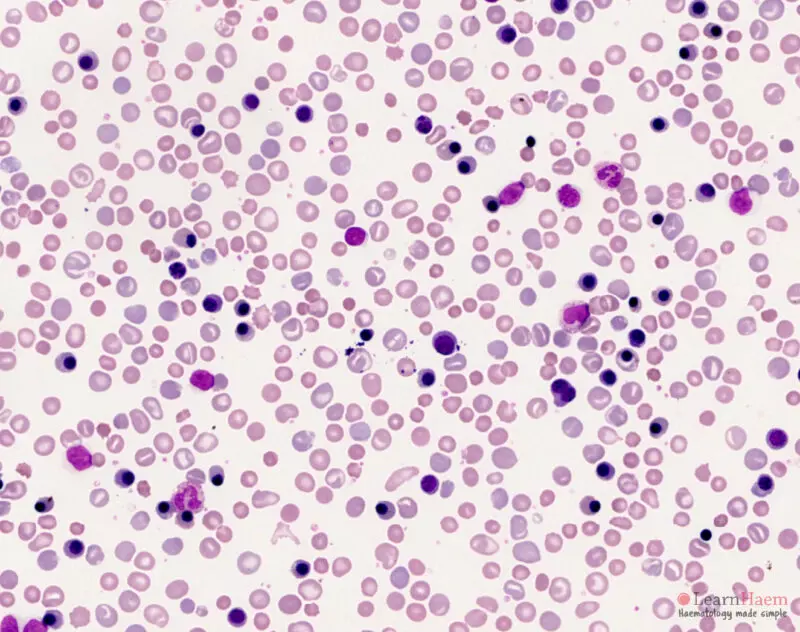 Polychromasia - LearnHaem | Haematology Made Simple