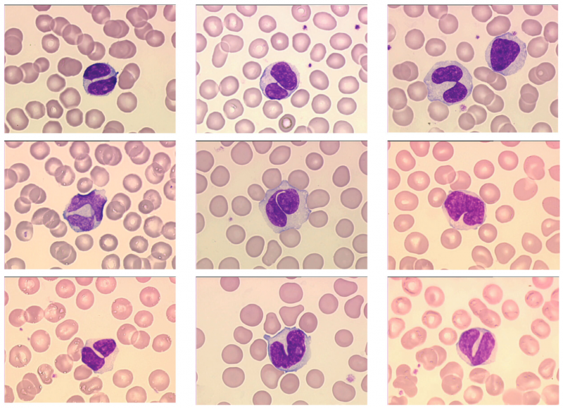 Reactive Lymphocytes / Benign Disorders - LearnHaem | Haematology Made ...