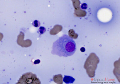 Multiple Myeloma - LearnHaem | Haematology Made Simple