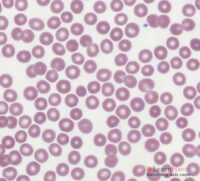 RBC Morphology Overview - LearnHaem | Haematology Made Simple