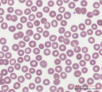 RBC Morphology Overview - LearnHaem | Haematology Made Simple