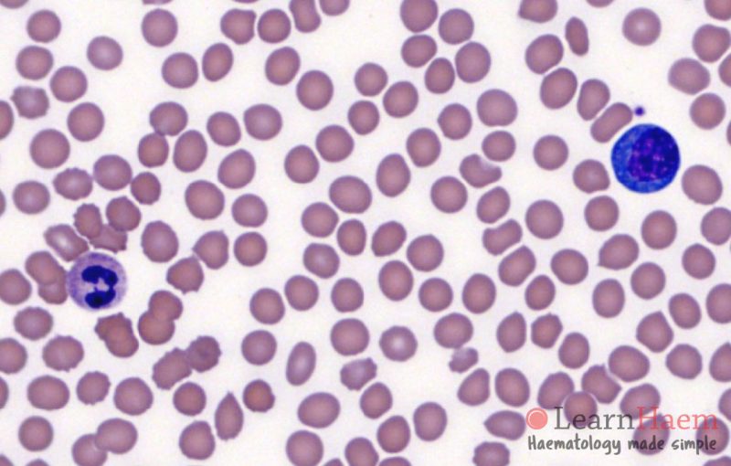 Reactive Lymphocytes / Benign Disorders - LearnHaem | Haematology Made ...