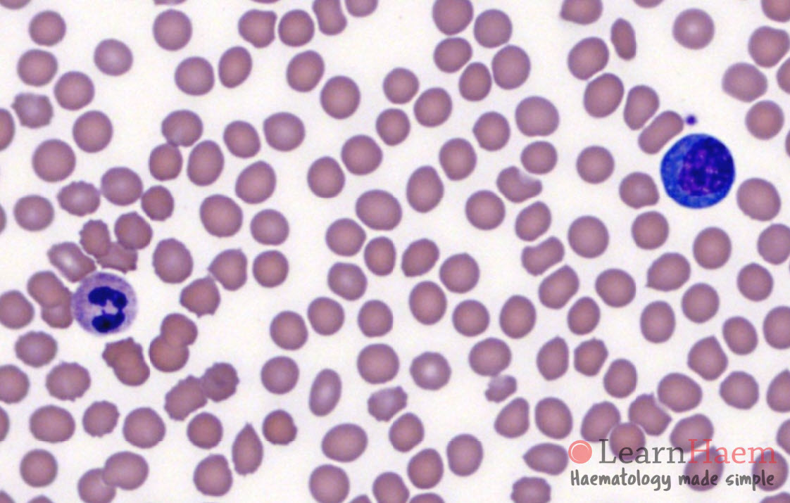 Reactive Lymphocytes / Benign Disorders - LearnHaem | Haematology Made ...