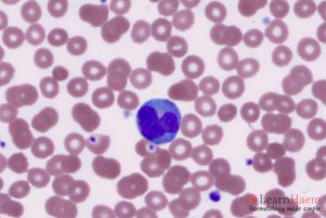 Reactive Lymphocytes / Benign Disorders - LearnHaem | Haematology Made ...