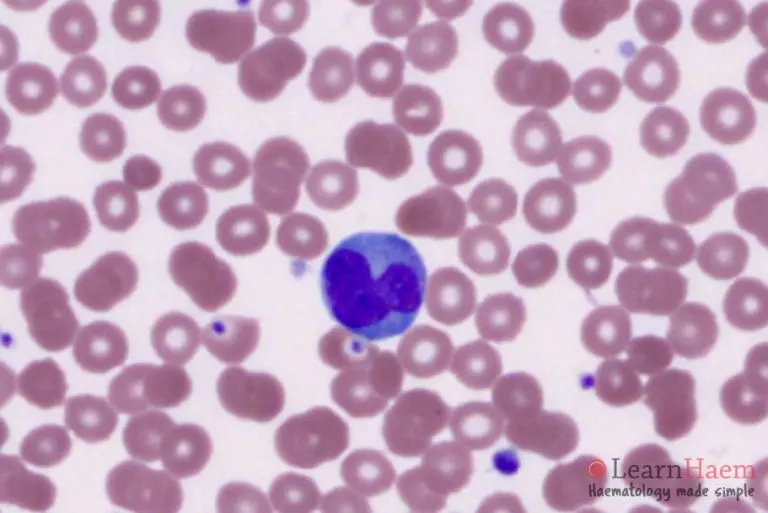 Reactive Lymphocytes / Benign Disorders - LearnHaem | Haematology Made ...
