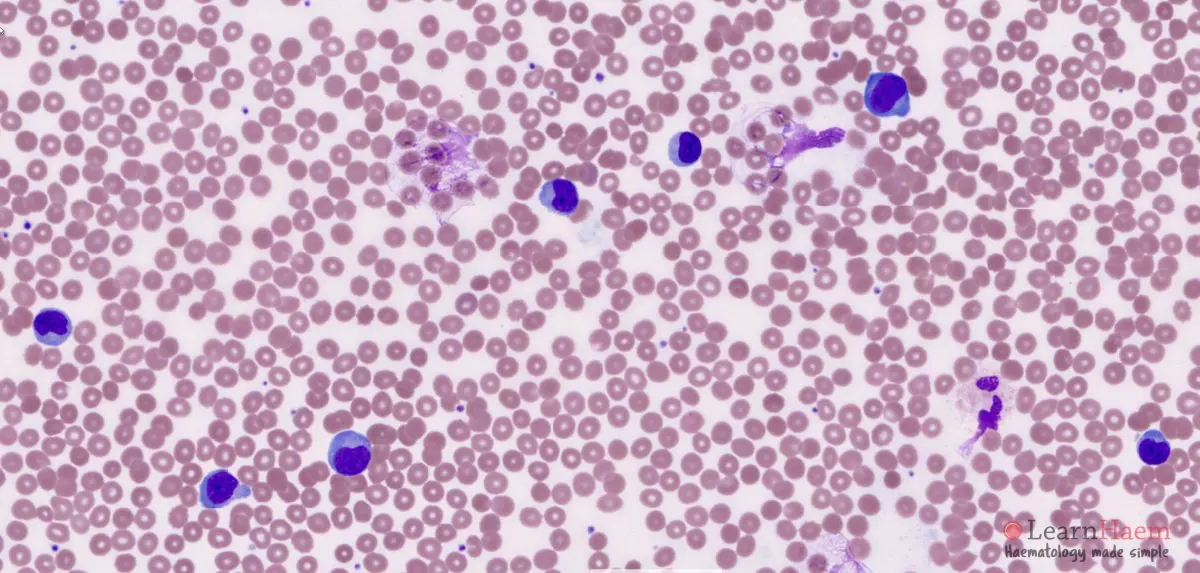 Reactive Lymphocytes / Benign Disorders - LearnHaem | Haematology Made ...