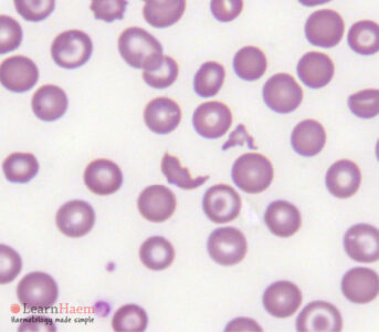 Schistocytes - LearnHaem | Haematology Made Simple