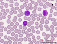 Sezary Syndrome - LearnHaem | Haematology Made Simple