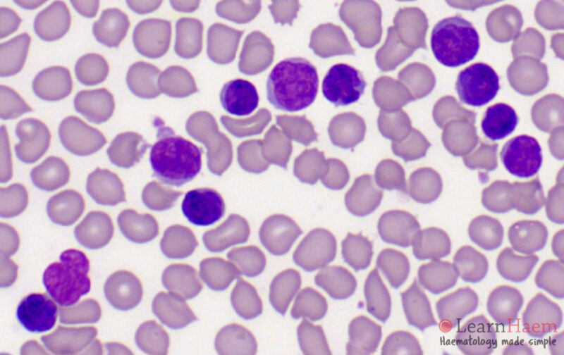 Sezary Syndrome - LearnHaem | Haematology Made Simple