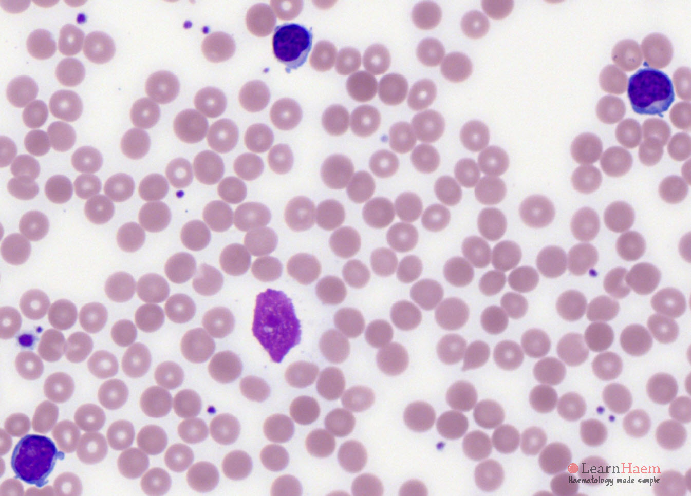 Marginal Zone Lymphoma - LearnHaem | Haematology Made Simple