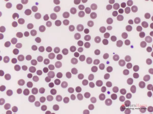 Spherocytes - LearnHaem | Haematology Made Simple