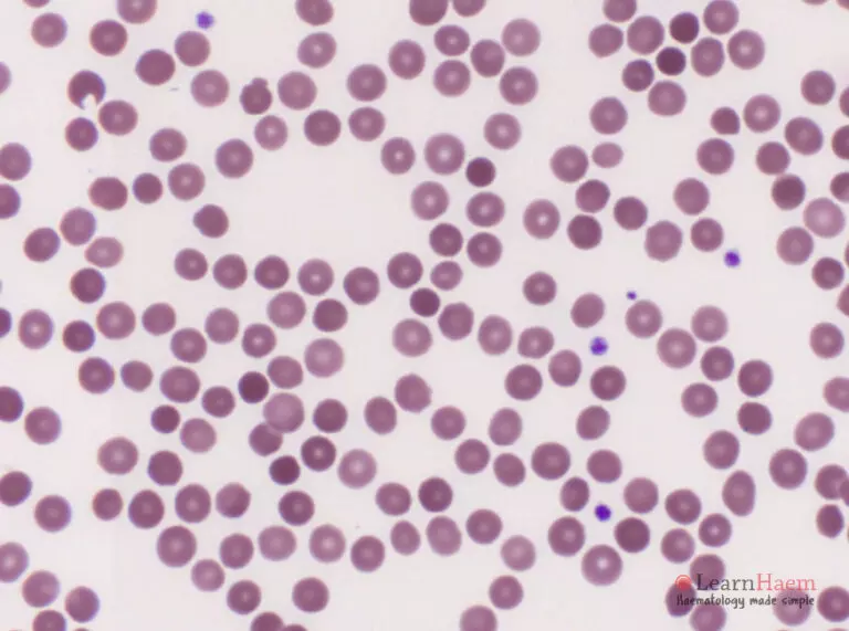 Spherocytes - LearnHaem | Haematology Made Simple