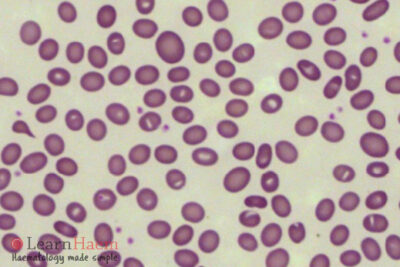 Stomatocytes - LearnHaem | Haematology Made Simple