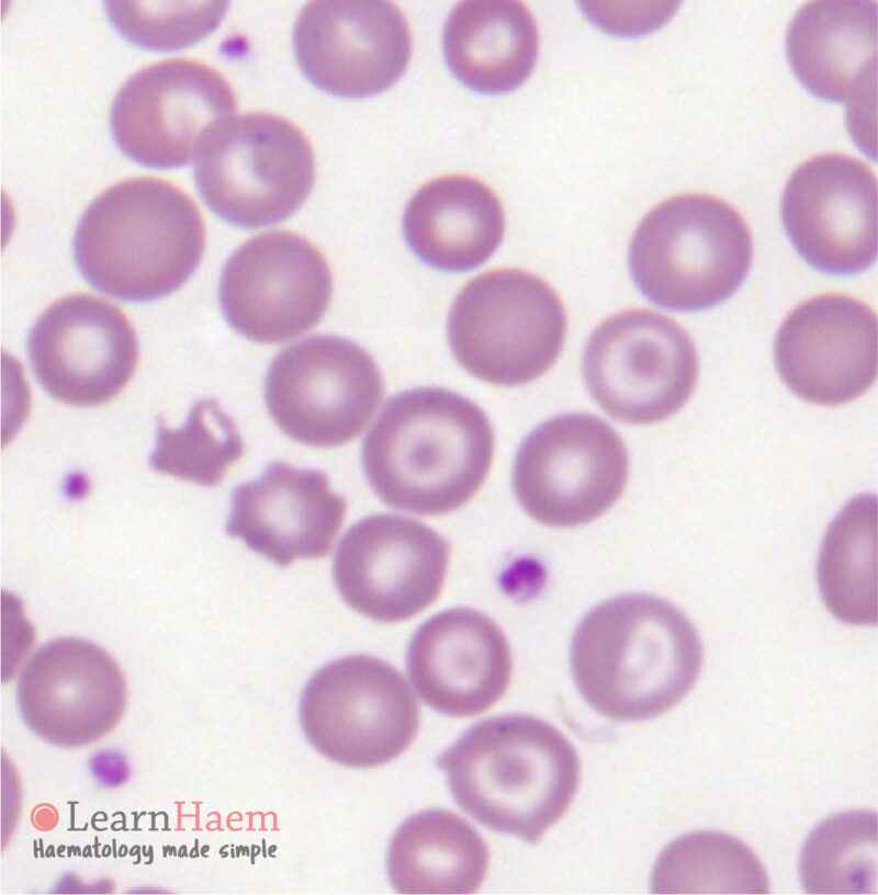 Target Cells - LearnHaem | Haematology Made Simple