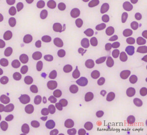 Teardrop Cells - LearnHaem | Haematology Made Simple