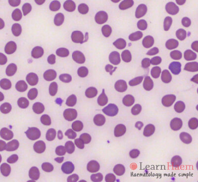 Teardrop Cells - LearnHaem | Haematology Made Simple