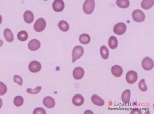 Teardrop Cells - LearnHaem | Haematology Made Simple