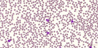 Southeast Asian Ovalocytosis - LearnHaem | Haematology Made Simple
