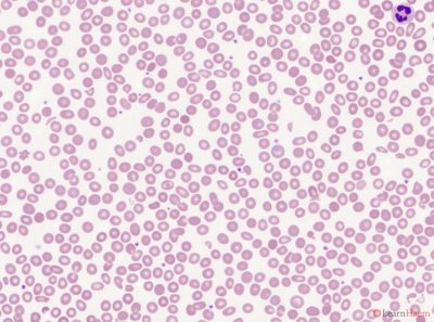 Beta Thalassaemia Trait - LearnHaem | Haematology Made Simple