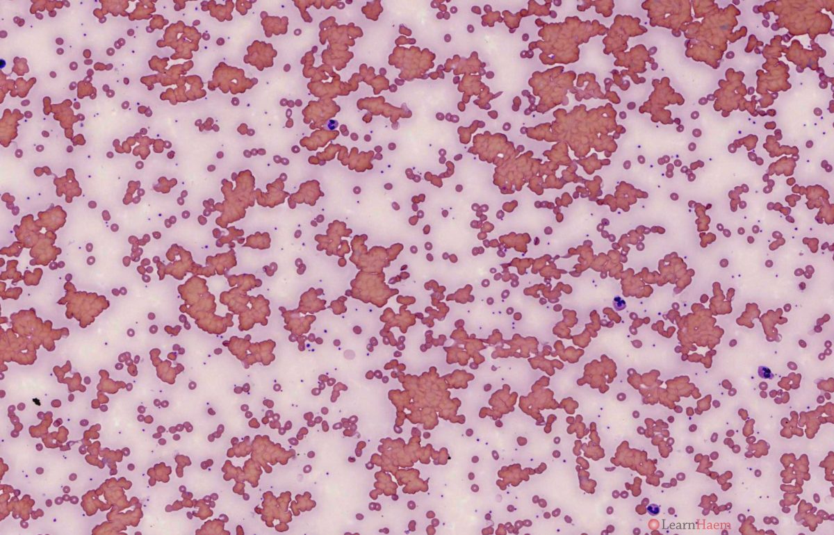 Cold Agglutinin Disease - LearnHaem | Haematology Made Simple